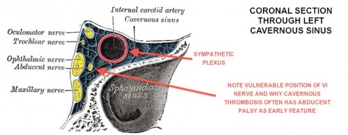 Horner’s Syndrome – Emergency Medicine Ireland