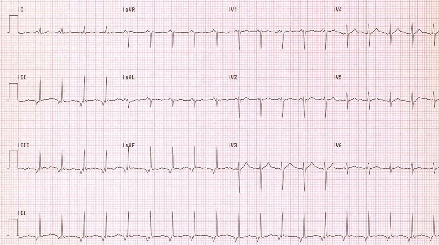 Tasty Morsels of EM 031 – Retrograde p waves – Emergency Medicine Ireland