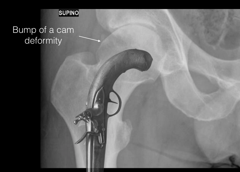 Tasty Morsels of EM 068 – Femoral Acetabular Impingement – Emergency ...